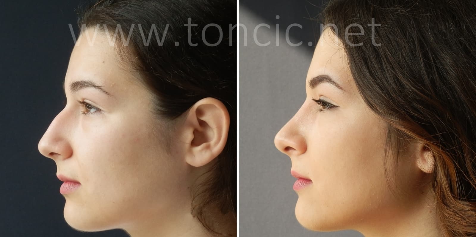 Nasenkorrektur | Rhinoplastik | Poliklinik dr. Tončić
