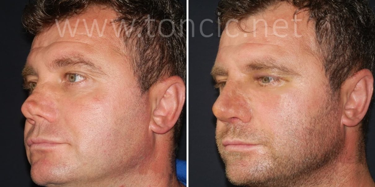 Nasenkorrektur | Rhinoplastik | Poliklinik dr. Tončić