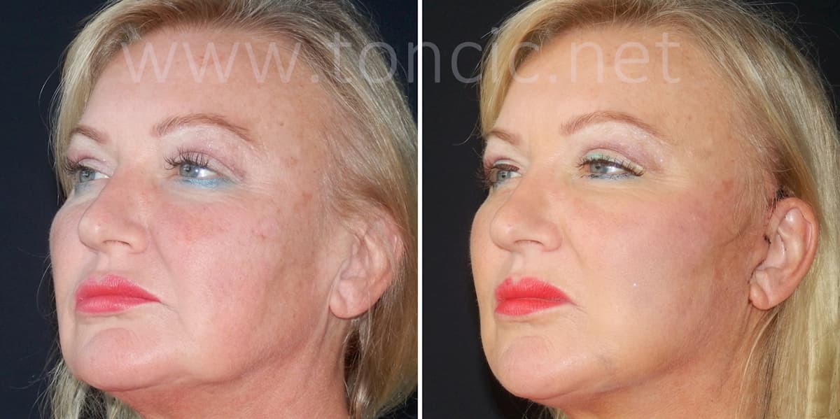 Mini lifting | S-Lifting | Poliklinik dr.Tončić