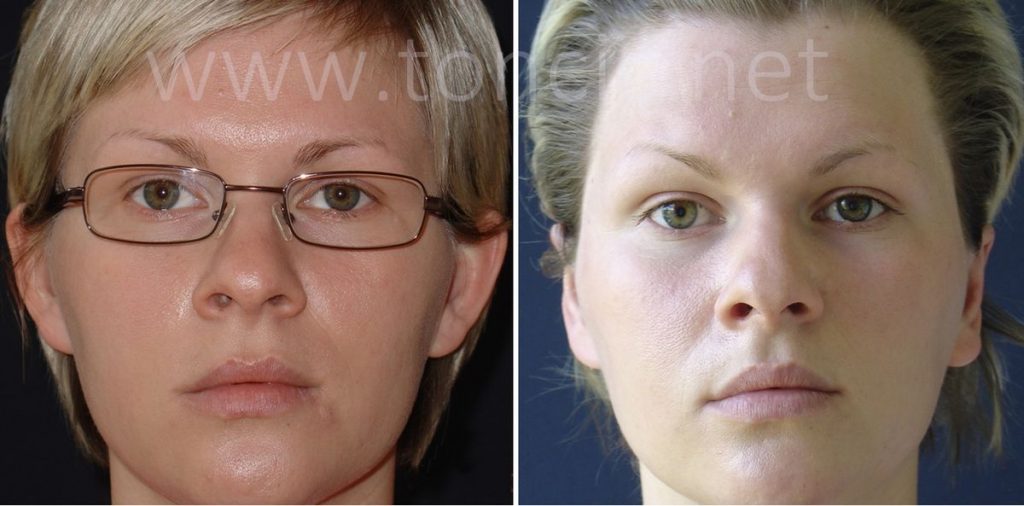 Otoplastik | Schönheitschirurgie Dr. Toncic | Schönheitsoperationen ...