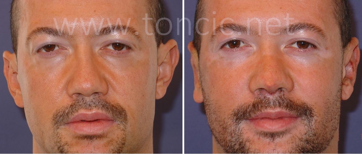 Otoplastik | Schönheitschirurgie Dr. Toncic | Schönheitsoperationen ...