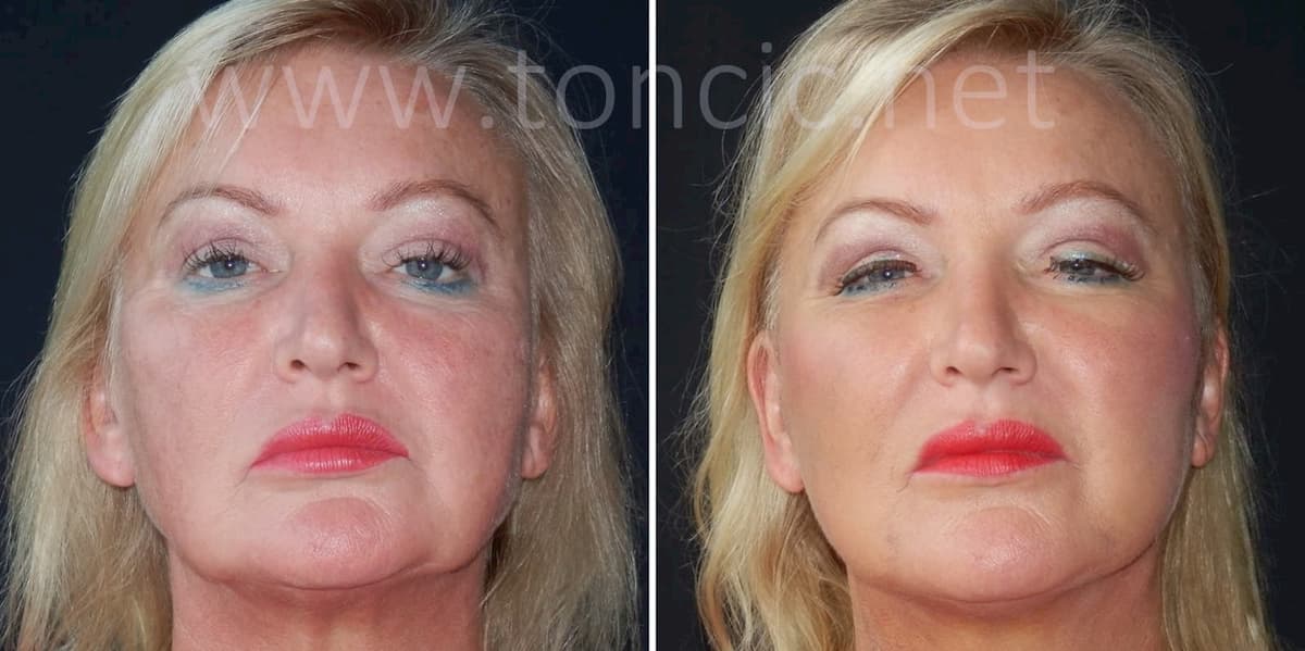Il lifting del viso e collo | Poliklinika dr. Tončić