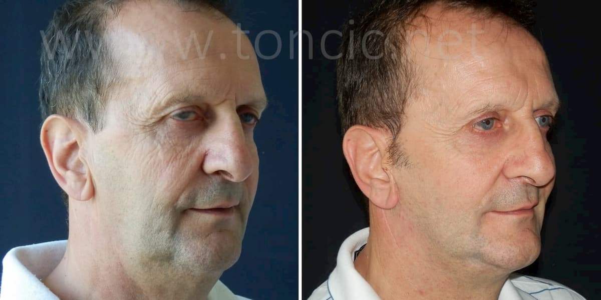 Il lifting del viso e collo | Poliklinika dr. Tončić