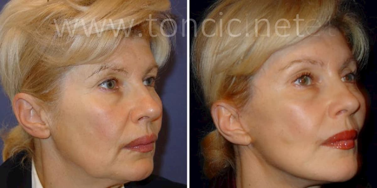 Il lifting del viso e collo | Poliklinika dr. Tončić