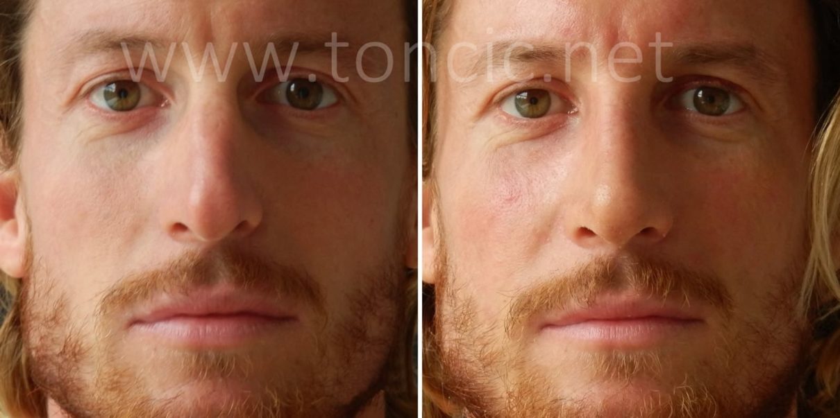 Operacija nosa | Rinoplastika | Poliklinika dr. Tončić
