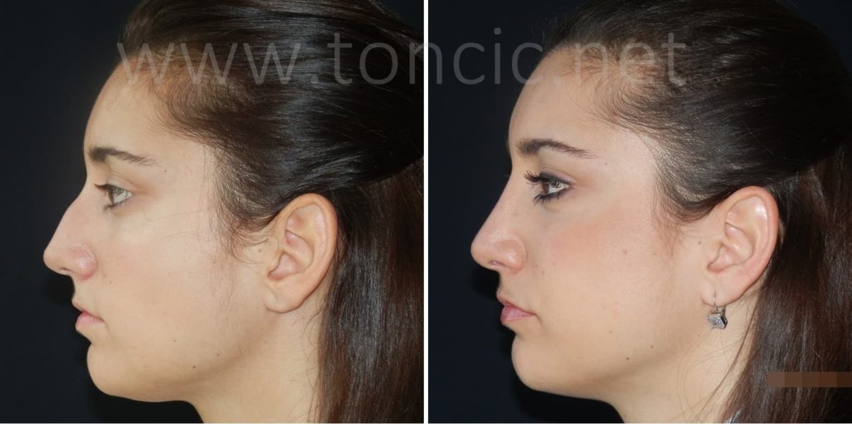 Operacija nosa | Rinoplastika | Poliklinika dr. Tončić