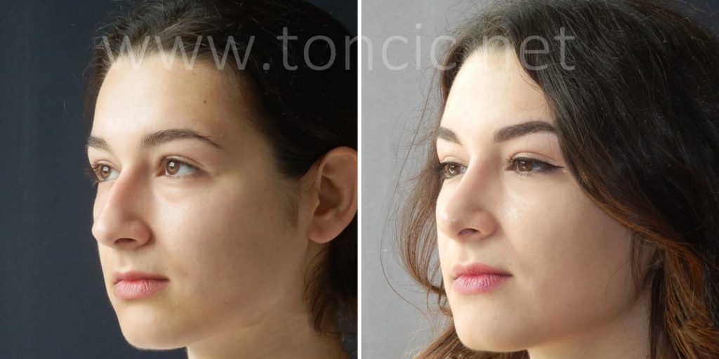 Operacija nosa | Rinoplastika | Poliklinika dr. Tončić