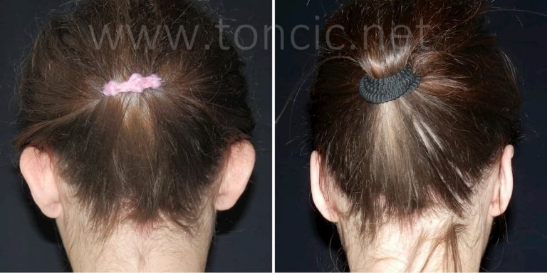 Estetska operacija ušiju | Otoplastika Zagreb | Poliklinika dr.Tončić